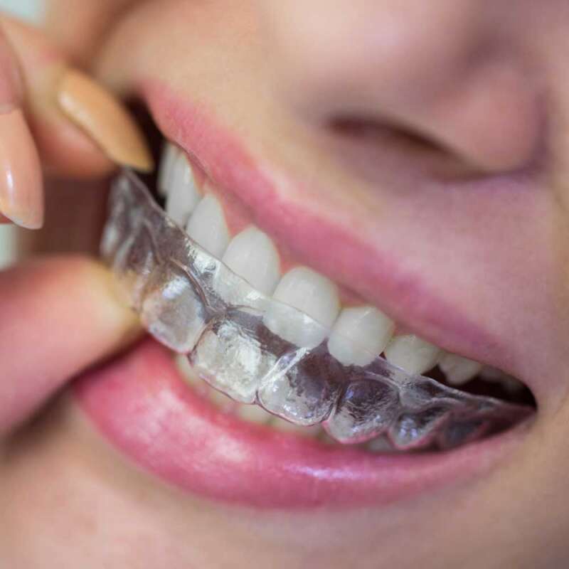 Premier Orthodontic Care | Arch Orthodontics in Hazelwood, MO